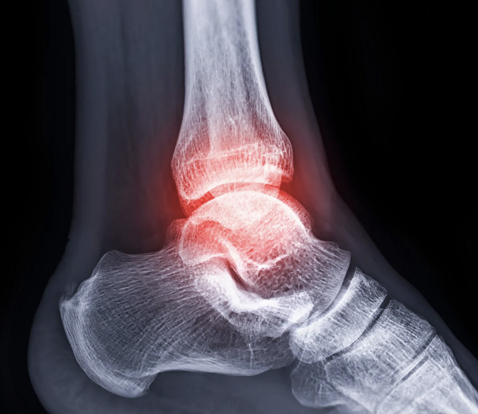 Ankle Replacement - Commonwealth Orthopaedic Associates